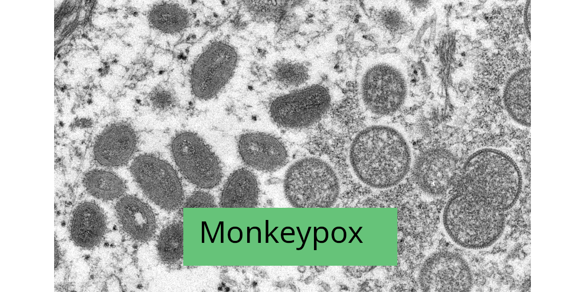 Monkeypox is now a national public health emergency in the U.S. – an ...